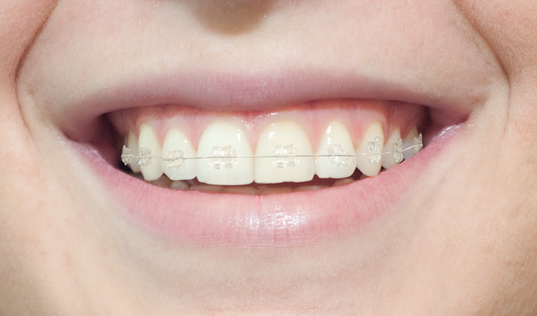 brackets-ninos - Dra. Gema Olmos